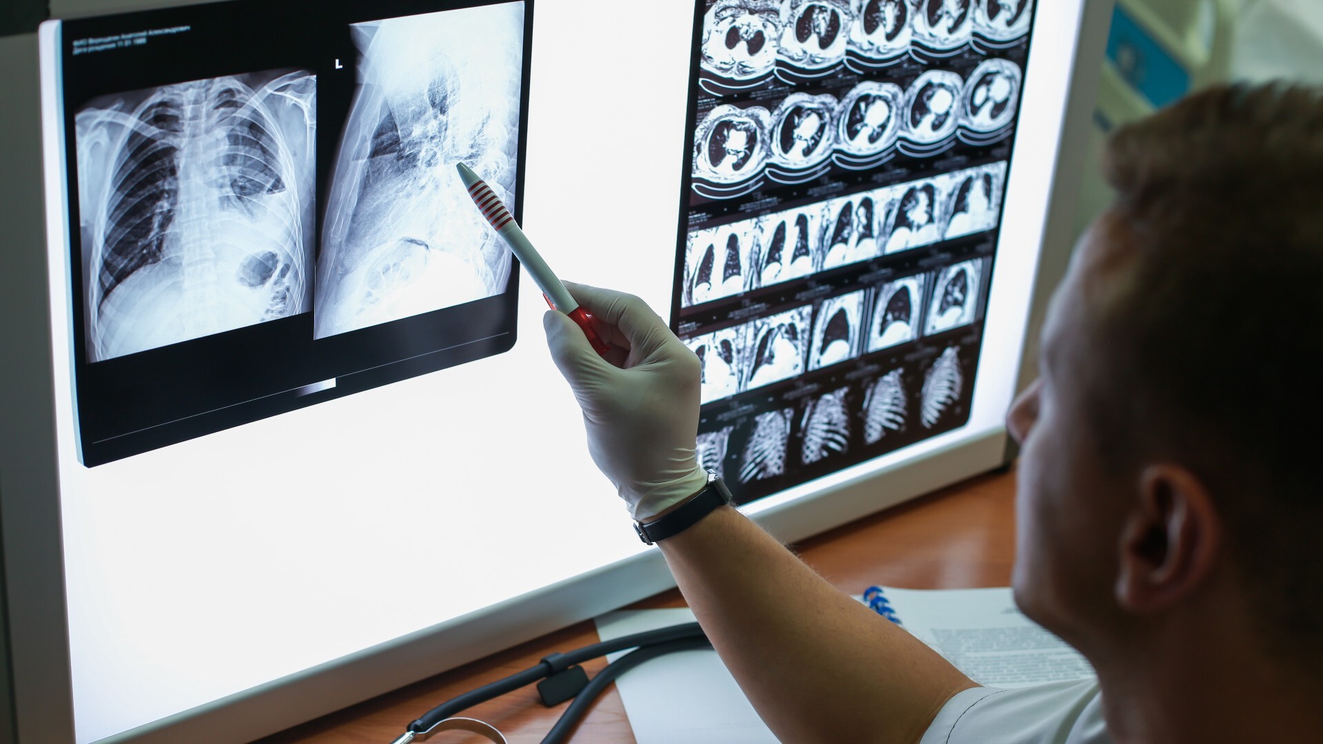 Hallan el 'talon de Aquiles' del cáncer de pulmón - RTVE.es
